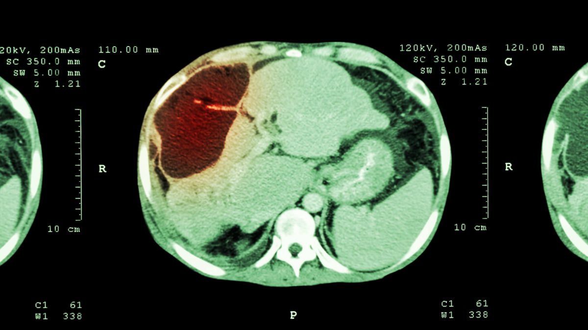 全身のがん検査ができるPET-CTとは？メリットや検査費用など解説 | セントラルメディカルクラブ世田谷