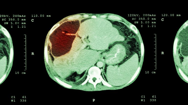 全身のがん検査ができるPET-CTとは？メリットや検査費用など解説 | セントラルメディカルクラブ世田谷